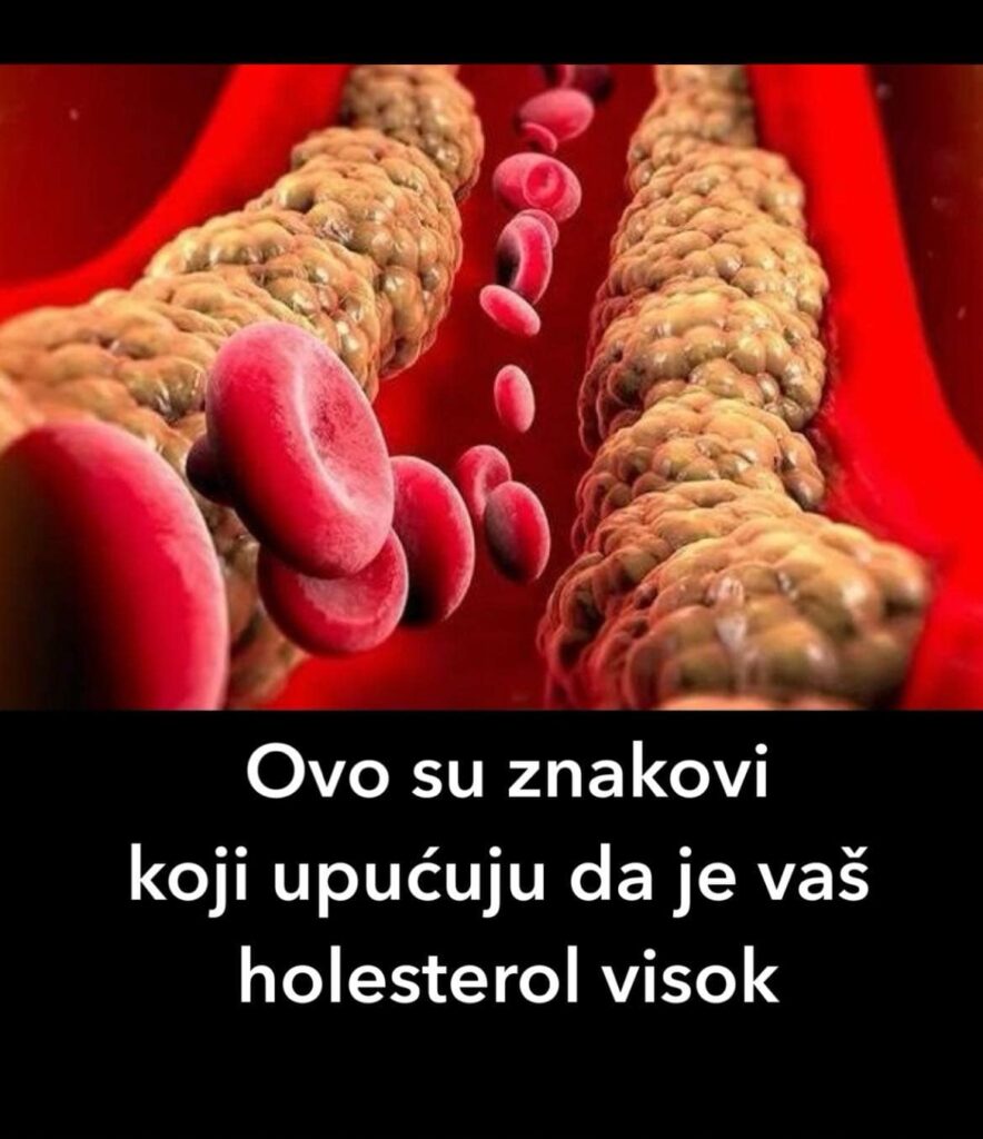 Ovo su znakovi koji upućuju da je vaš holesterol visok – Tražiš Posao?